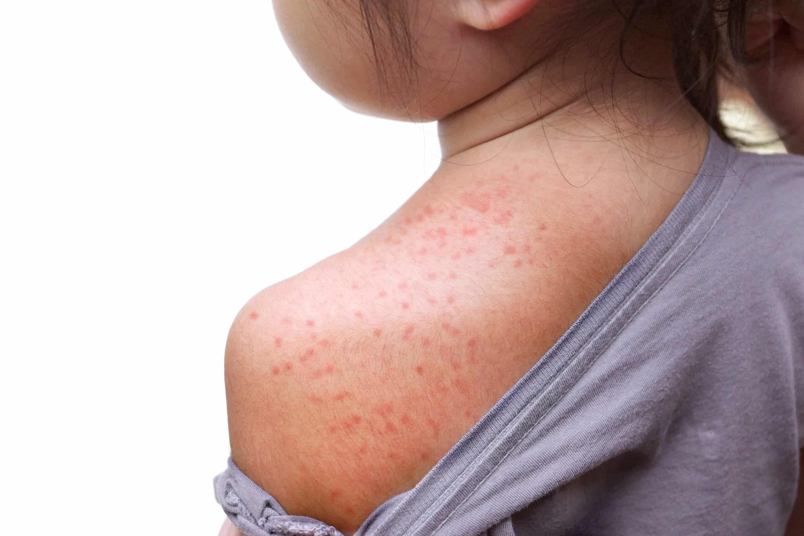 Recognising Mumps, Measles and Hand Foot and Mouth Disease